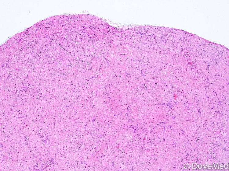 Leiomyoma of Kidney