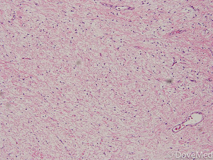 Angiomyxoma