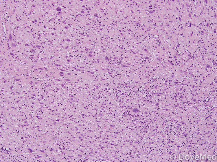 Synovial Sarcoma of Heart