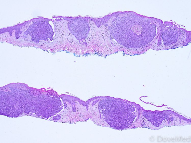 Basal Cell Carcinoma of Skin