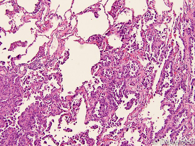 Colloid Adenocarcinoma of Lung