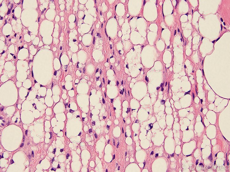 Endobronchial Lipoma