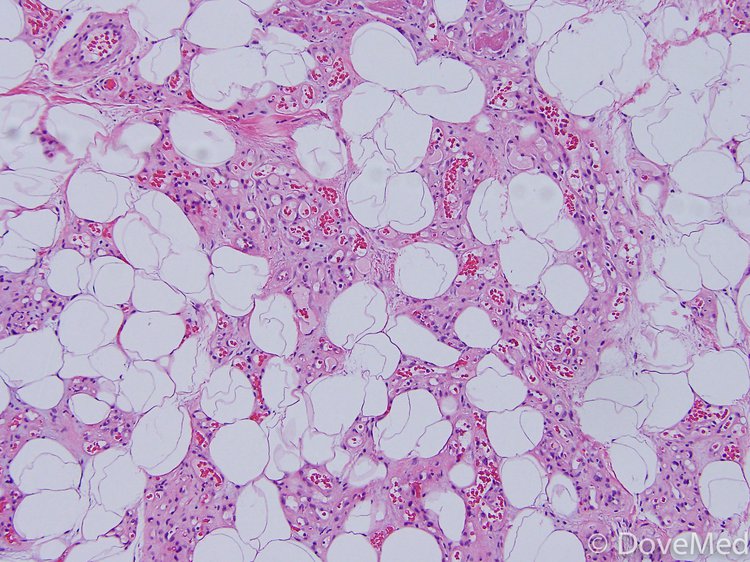 Angiolipoma of Breast