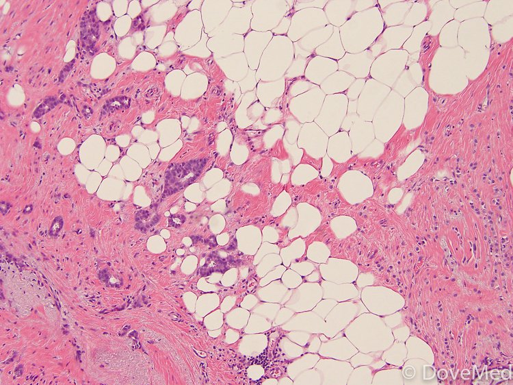 Mixed Type Infiltrating Carcinoma of Breast