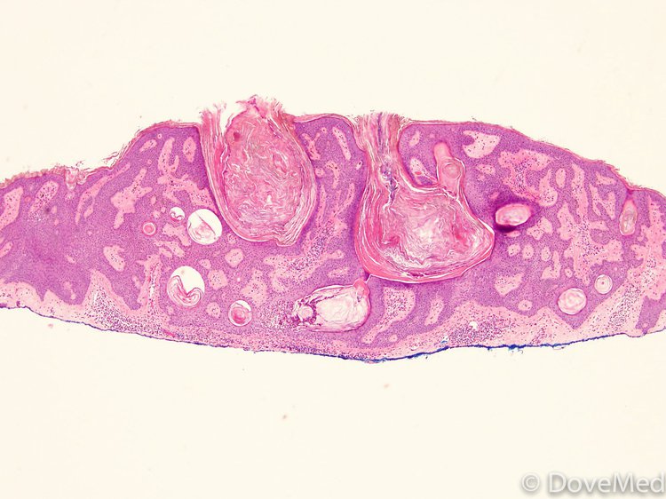 Seborrheic Keratosis of Skin