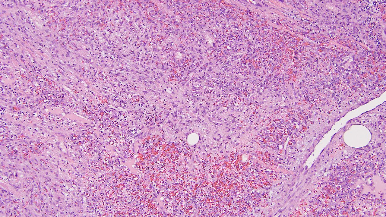 How well do you know Angiosarcoma of Skin?