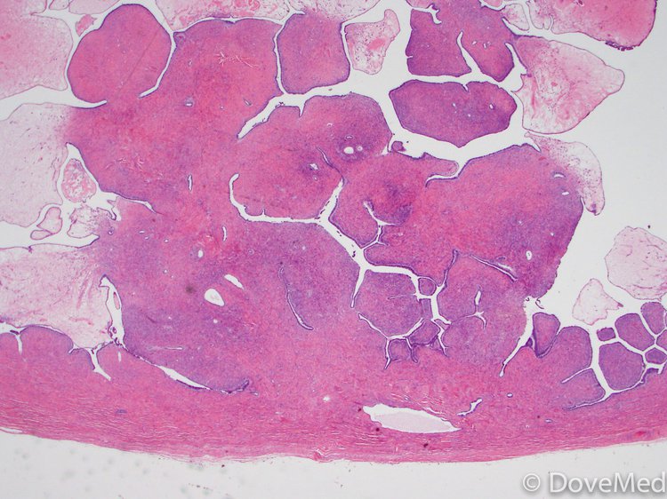 Benign Endometrioid Adenofibroma of Ovary