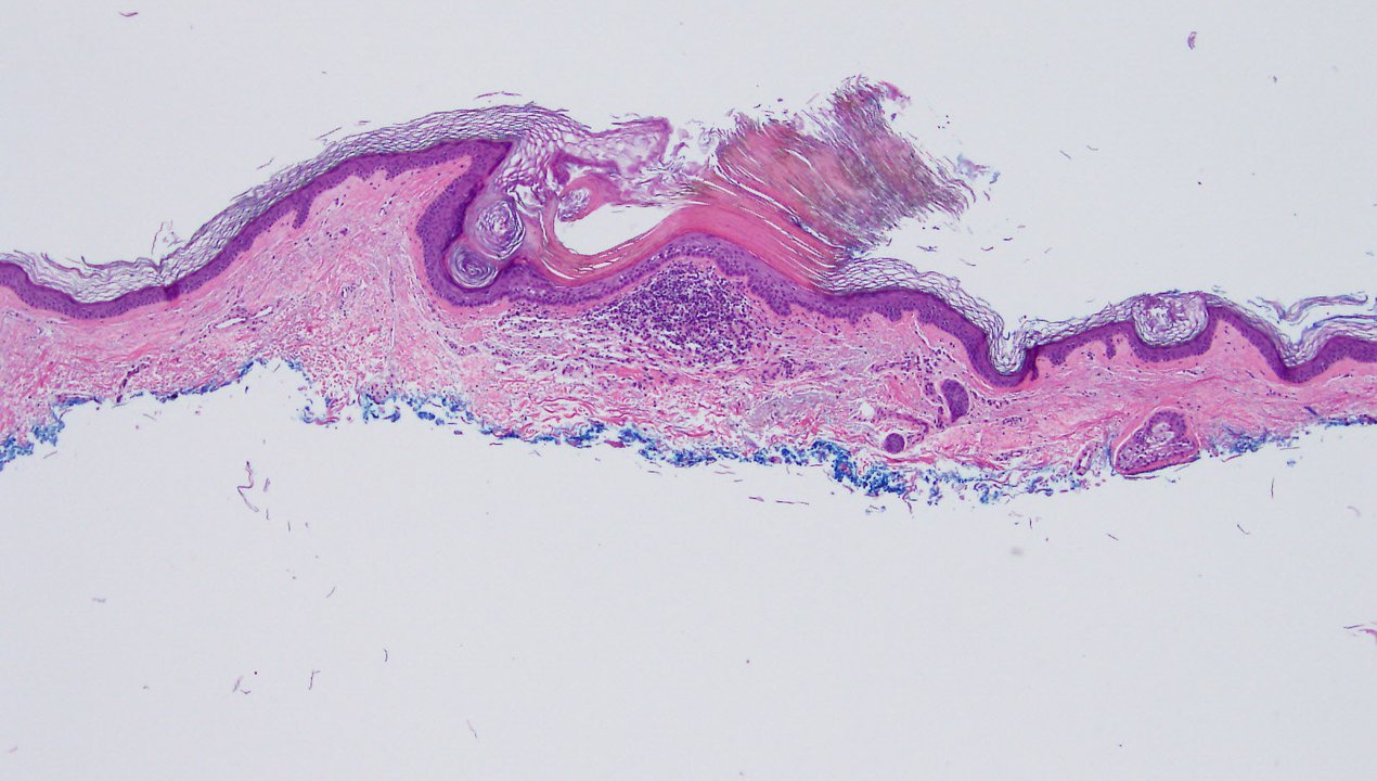 Actinic Keratosis of Skin