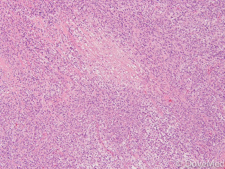 Solitary Fibrous Tumor of Thyroid