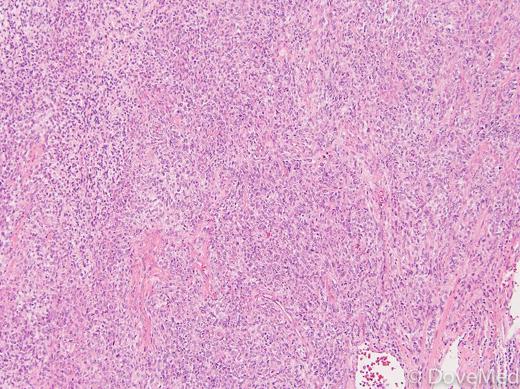 Solitary Fibrous Tumor Of Breast Solitary Fibrous Tumor Of Breast
