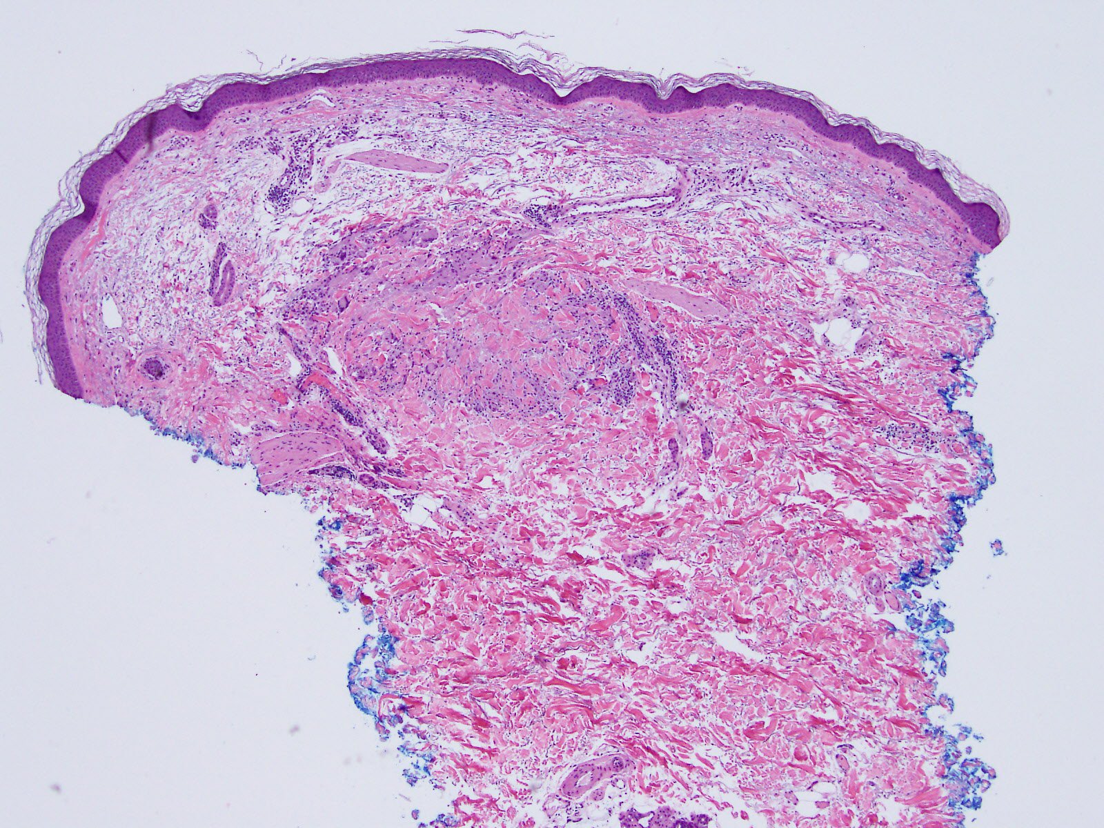Granuloma Annulare Histopathology