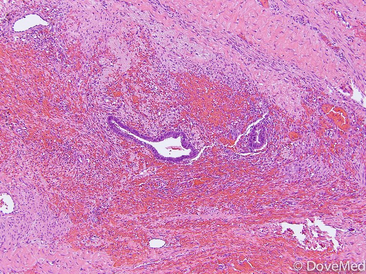 Endometriosis of Appendix