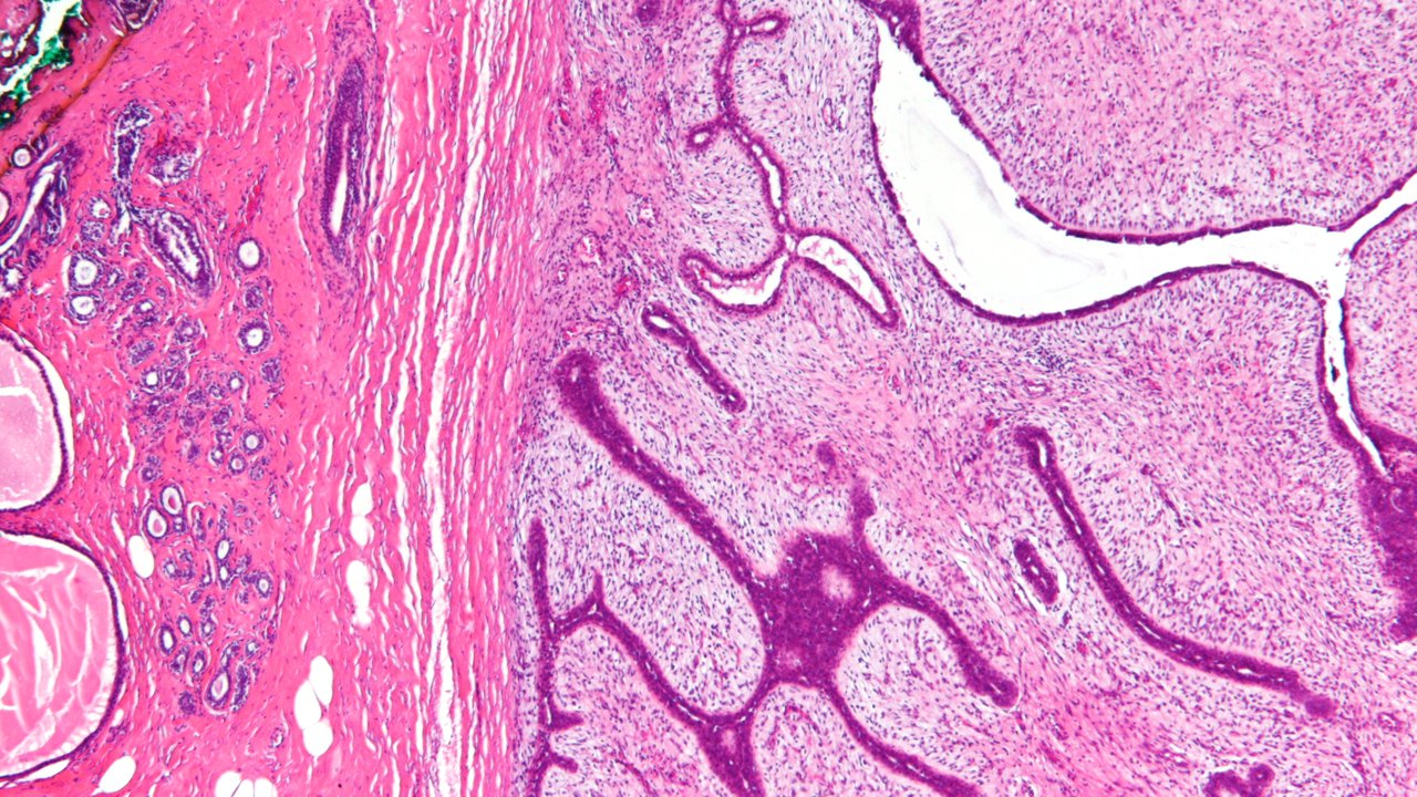 How well do you know Phyllodes Tumor of Breast?