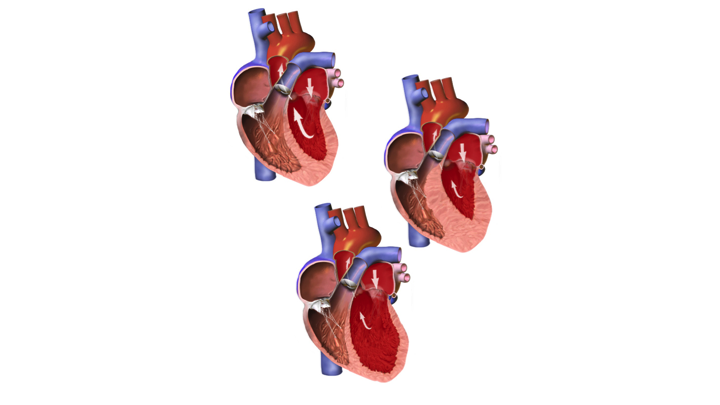 Cardiomyopathy