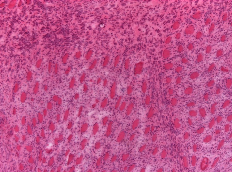 Proliferative Myositis