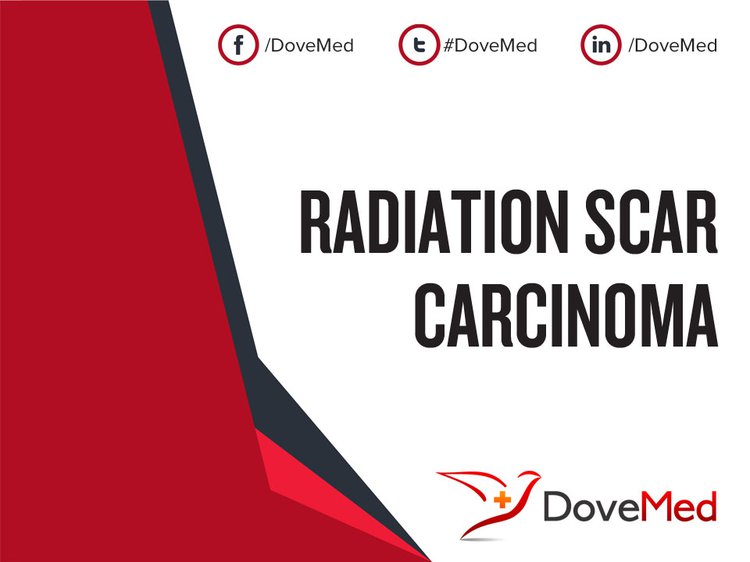 Radiation Scar Carcinoma