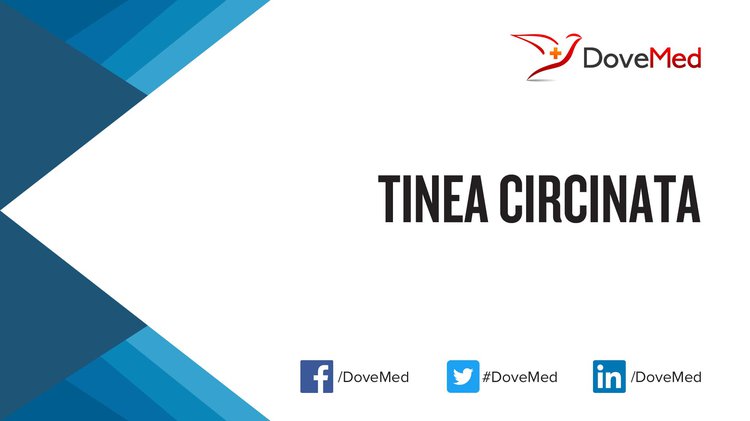 Tinea Circinata