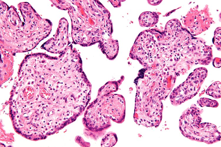 Villitis of Unknown Etiology