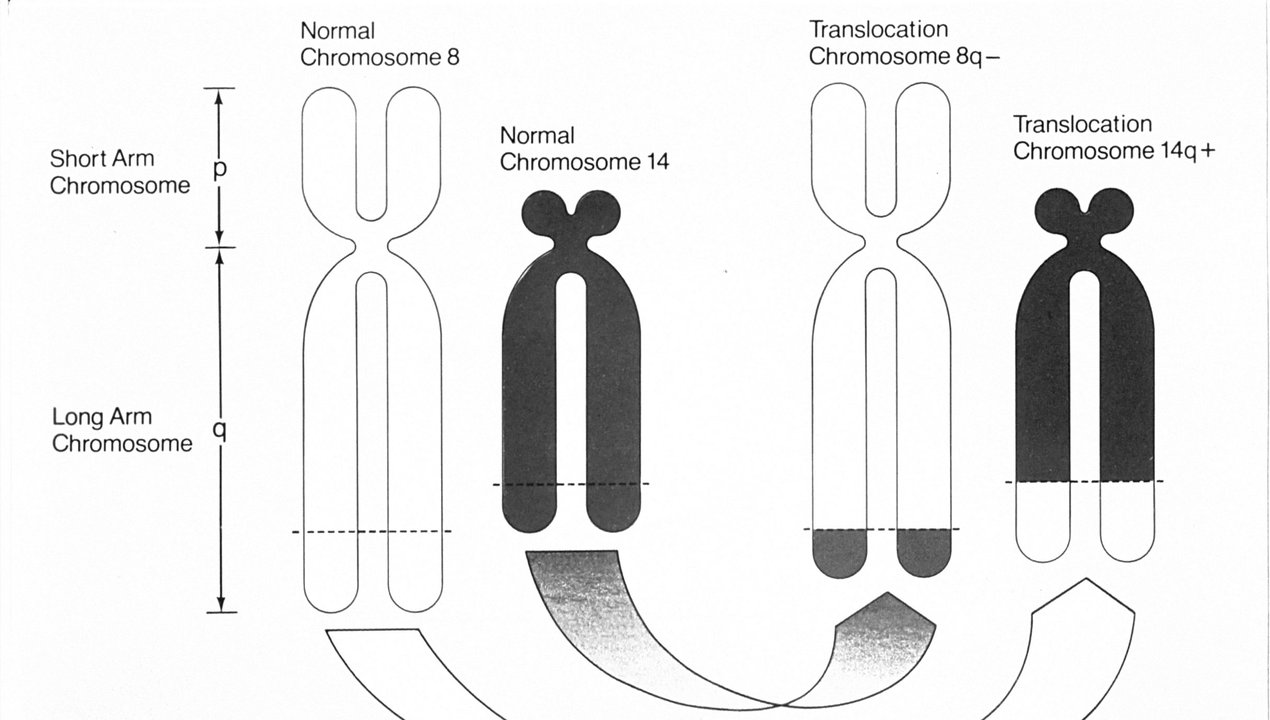 Burkitt Lymphoma