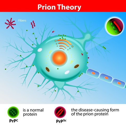 Down Syndrome, Like Alzheimer's, Is A Double-Prion Disorder, Study Shows