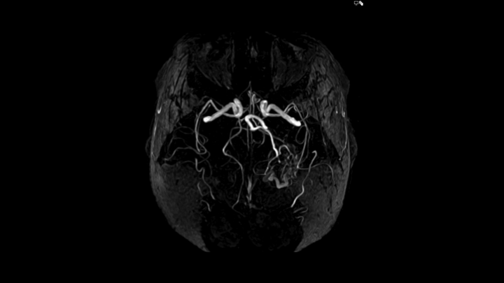 Embolization of Arteriovenous Malformation and Fistula in Brain