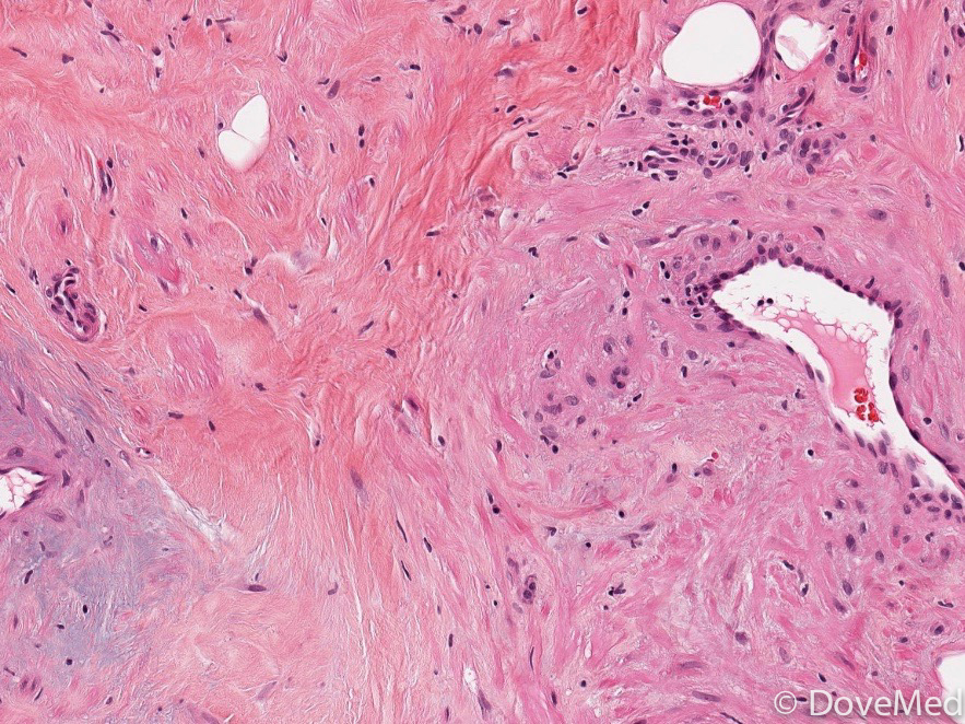 Angiomyolipoma of Stomach