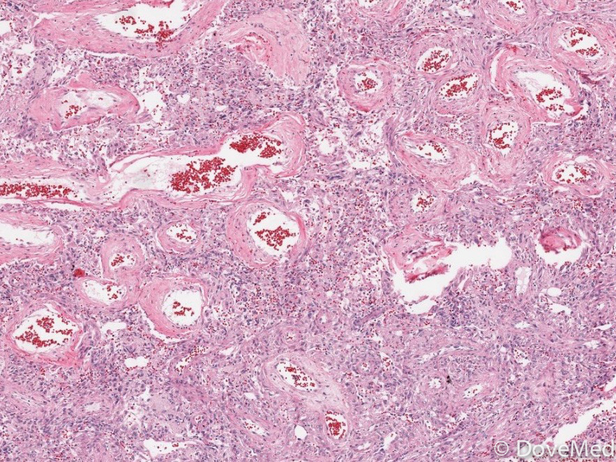 Angiomyolipoma of Lung