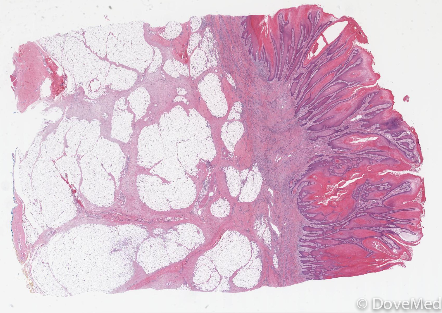 Verrucous Carcinoma of Bladder