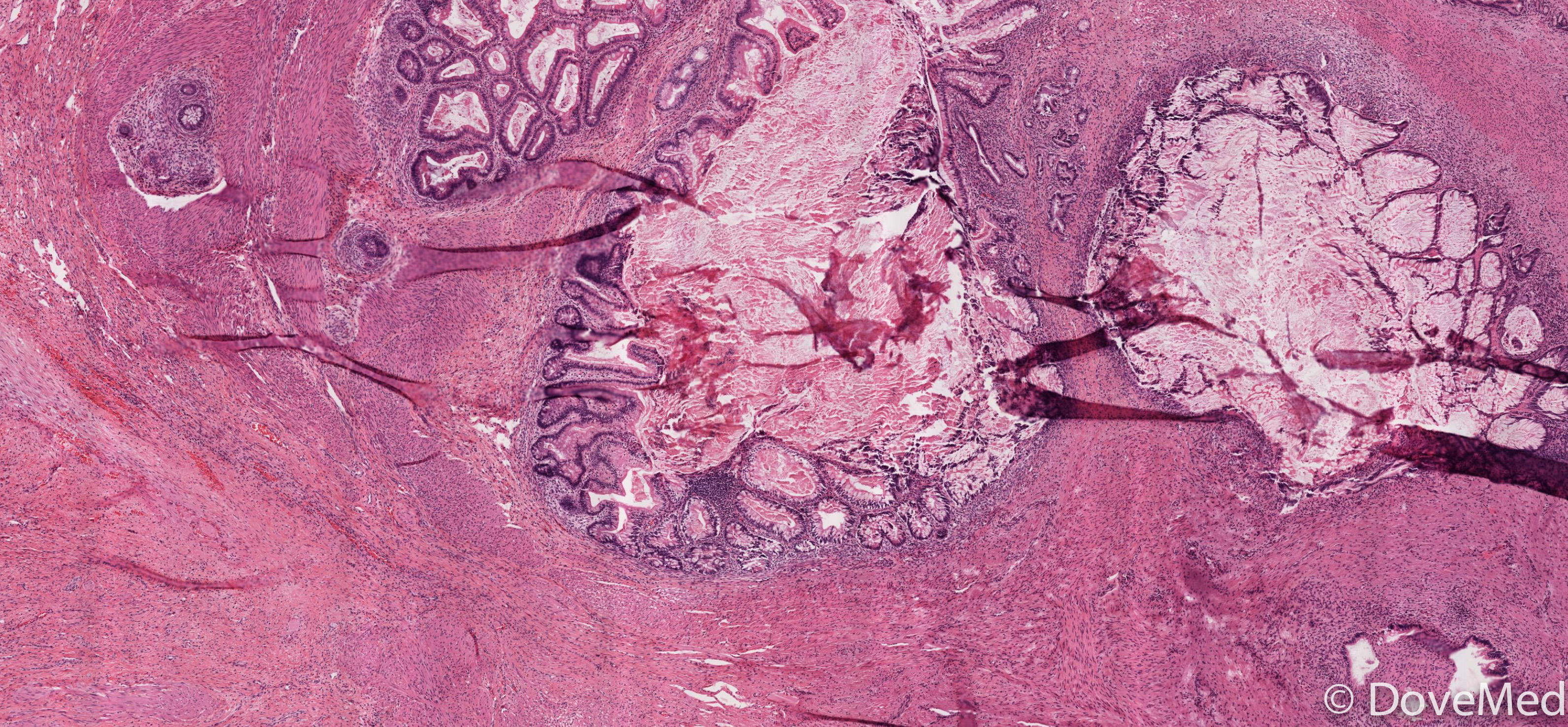 Teratoma Histology