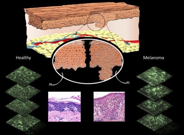 Non-Invasive Test Offers Quick Skin Cancer Diagnosis