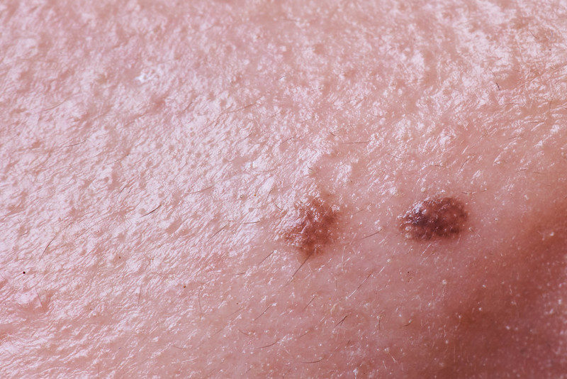 How Moles Change Into Melanoma