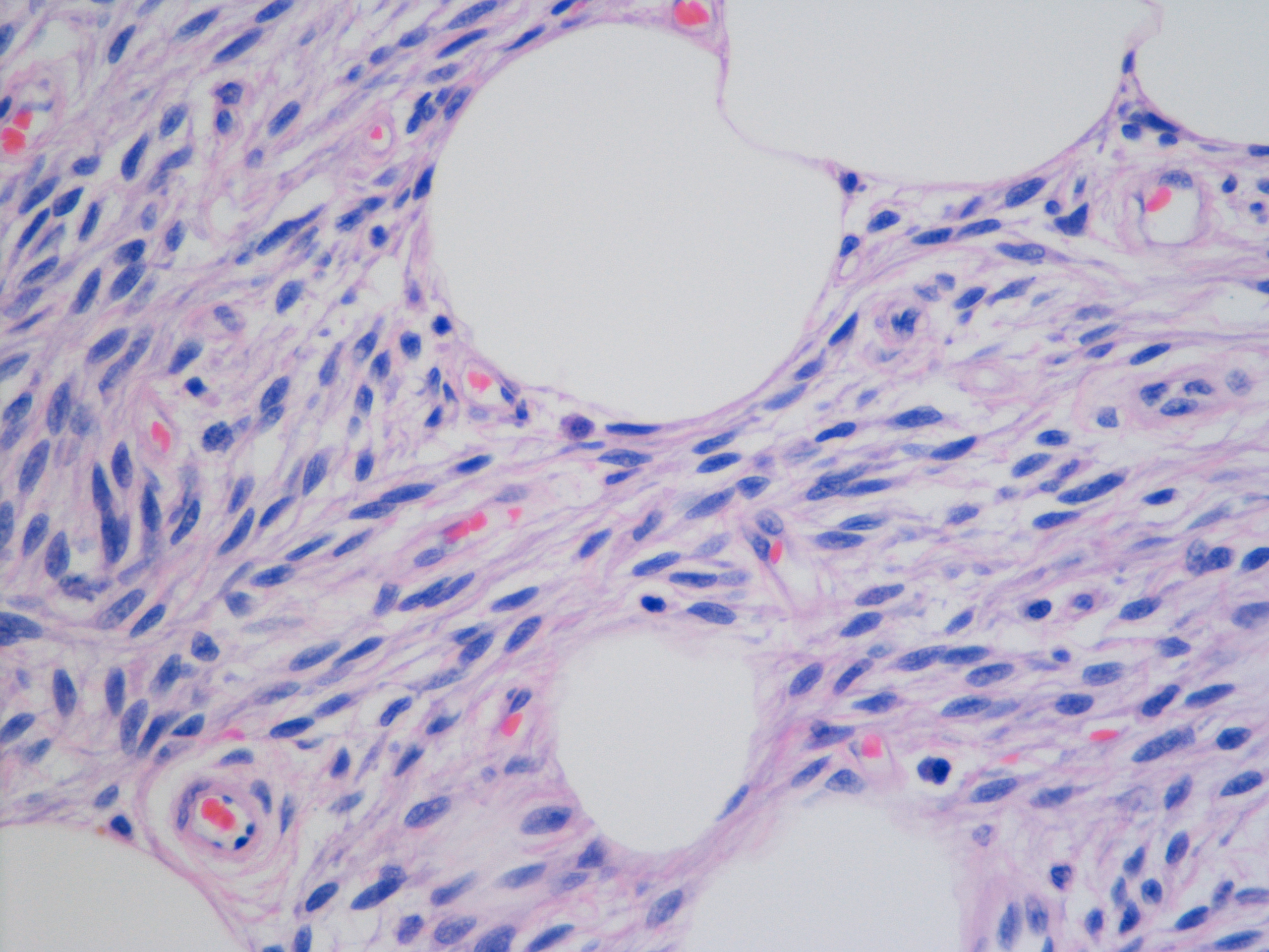 Spindle Cell Lipoma of Uterine Cervix