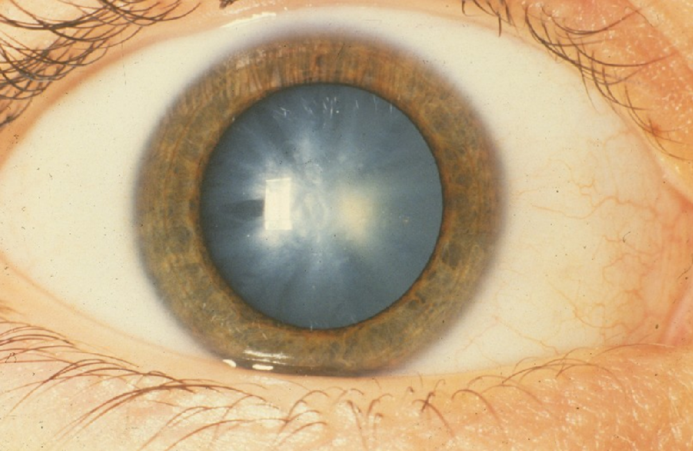 Rubella Cataract Rubella Cataract