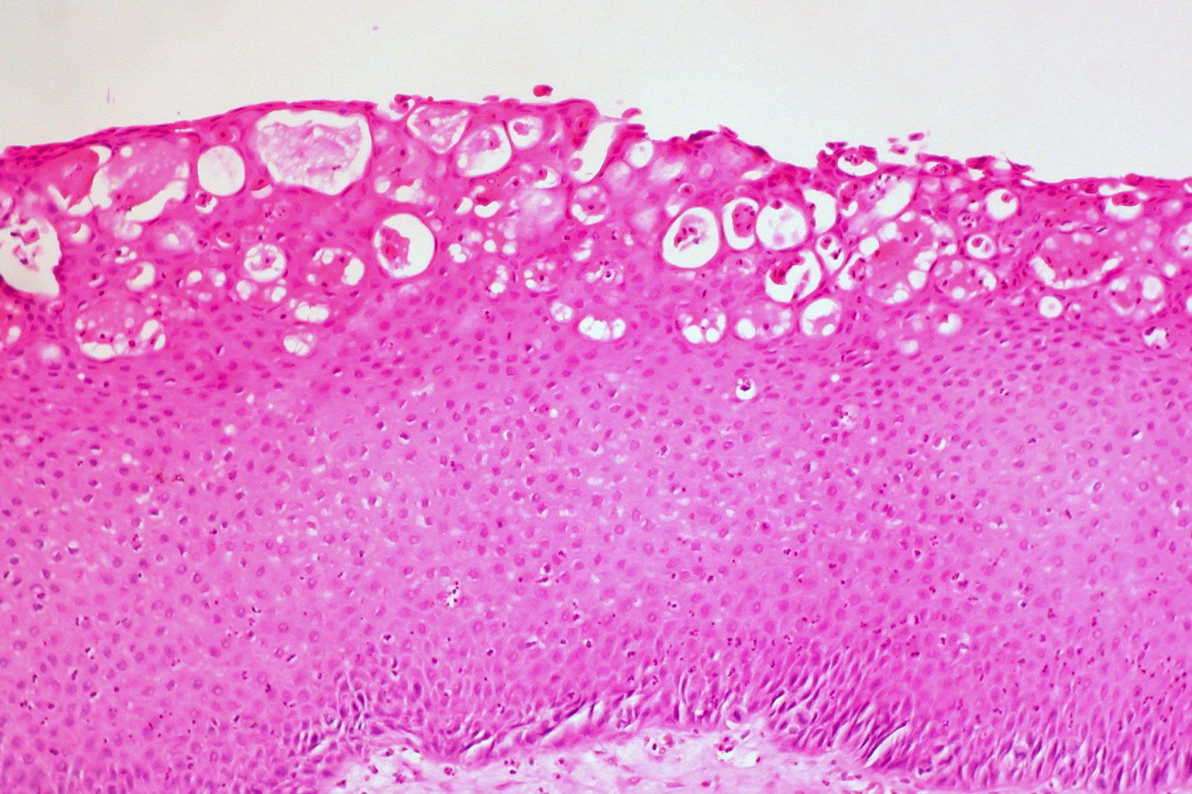 Inverted Papilloma Nasal Papilomul Invertit Nasal inverted papilloma ...