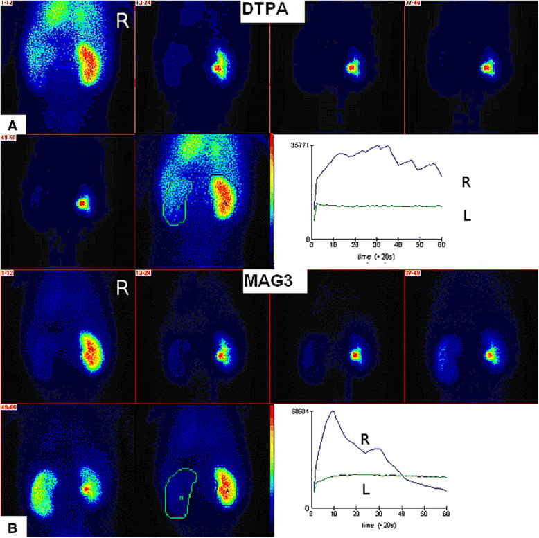 Renal Scintigraphy