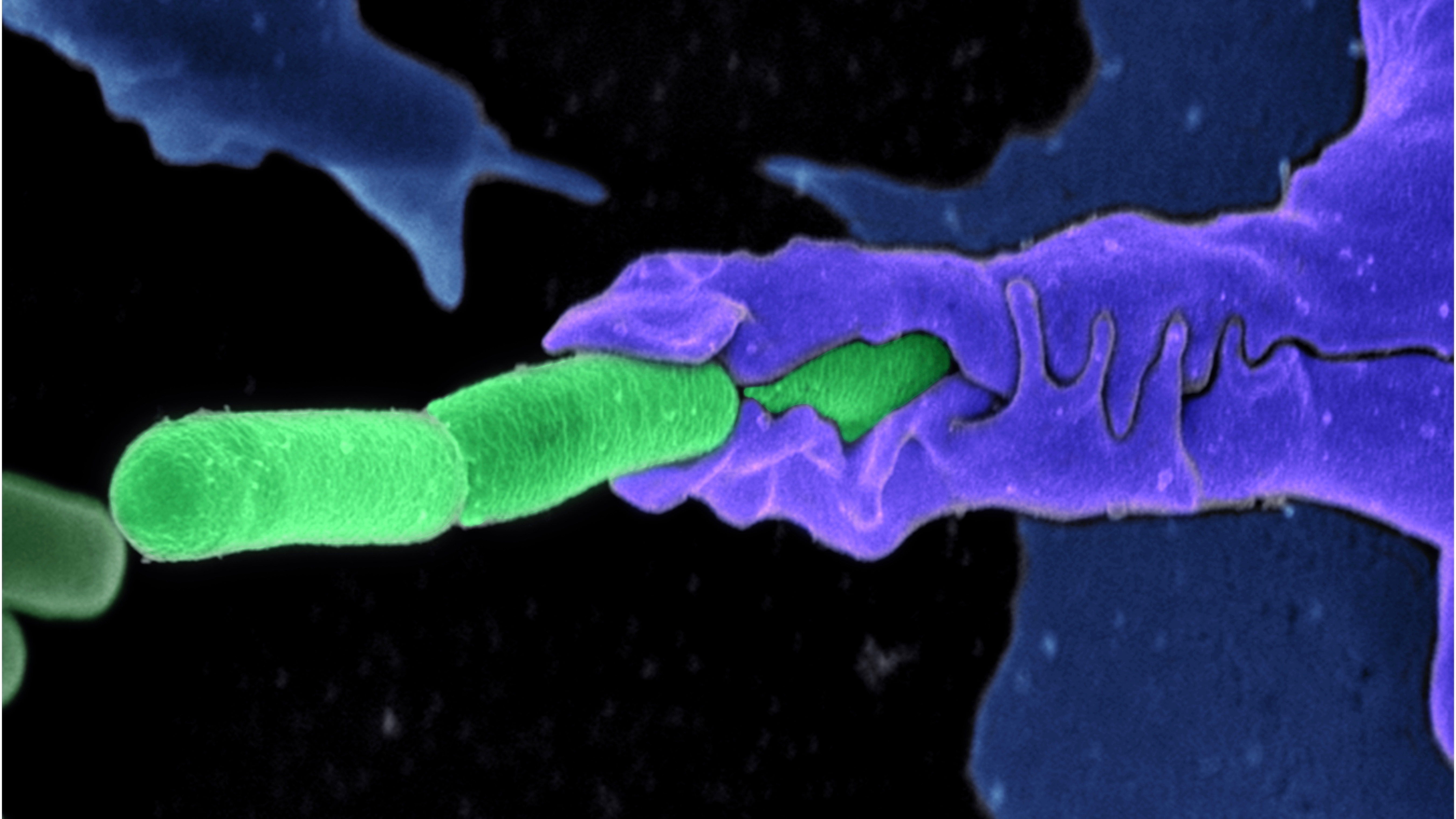 New Hope For 'Bubble Baby Disease'