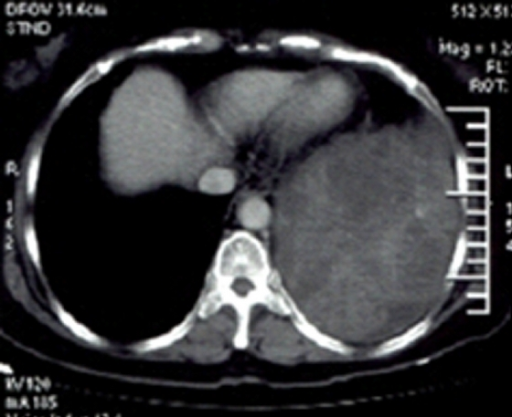 Angiosarcoma of Soft Tissue