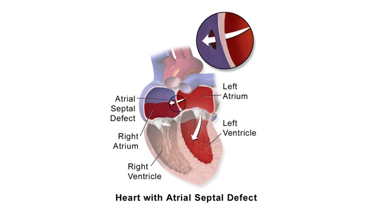 Atrial Septal Defect