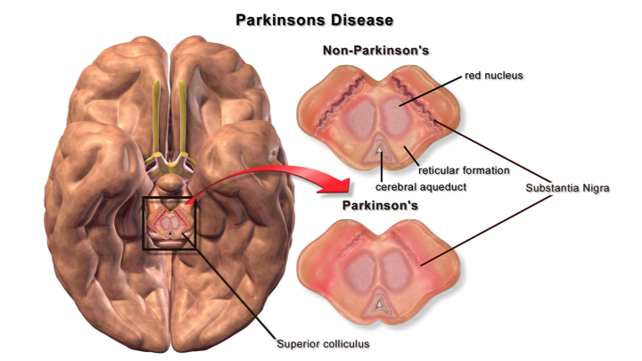 Parkinson’s Disease (PD)