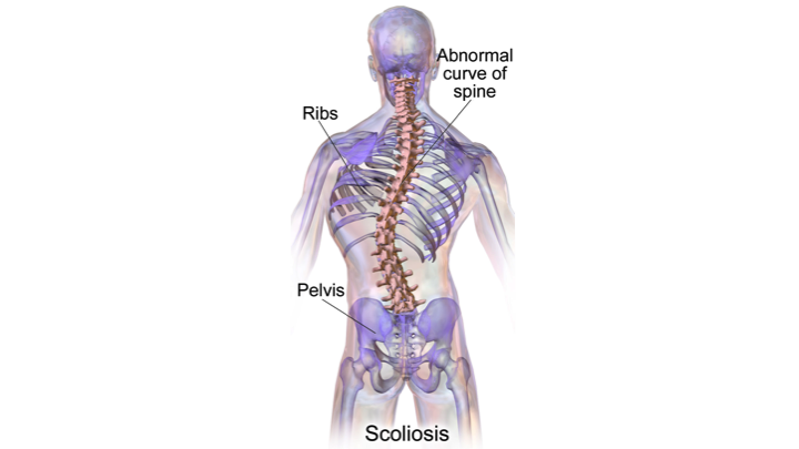 Scoliosis