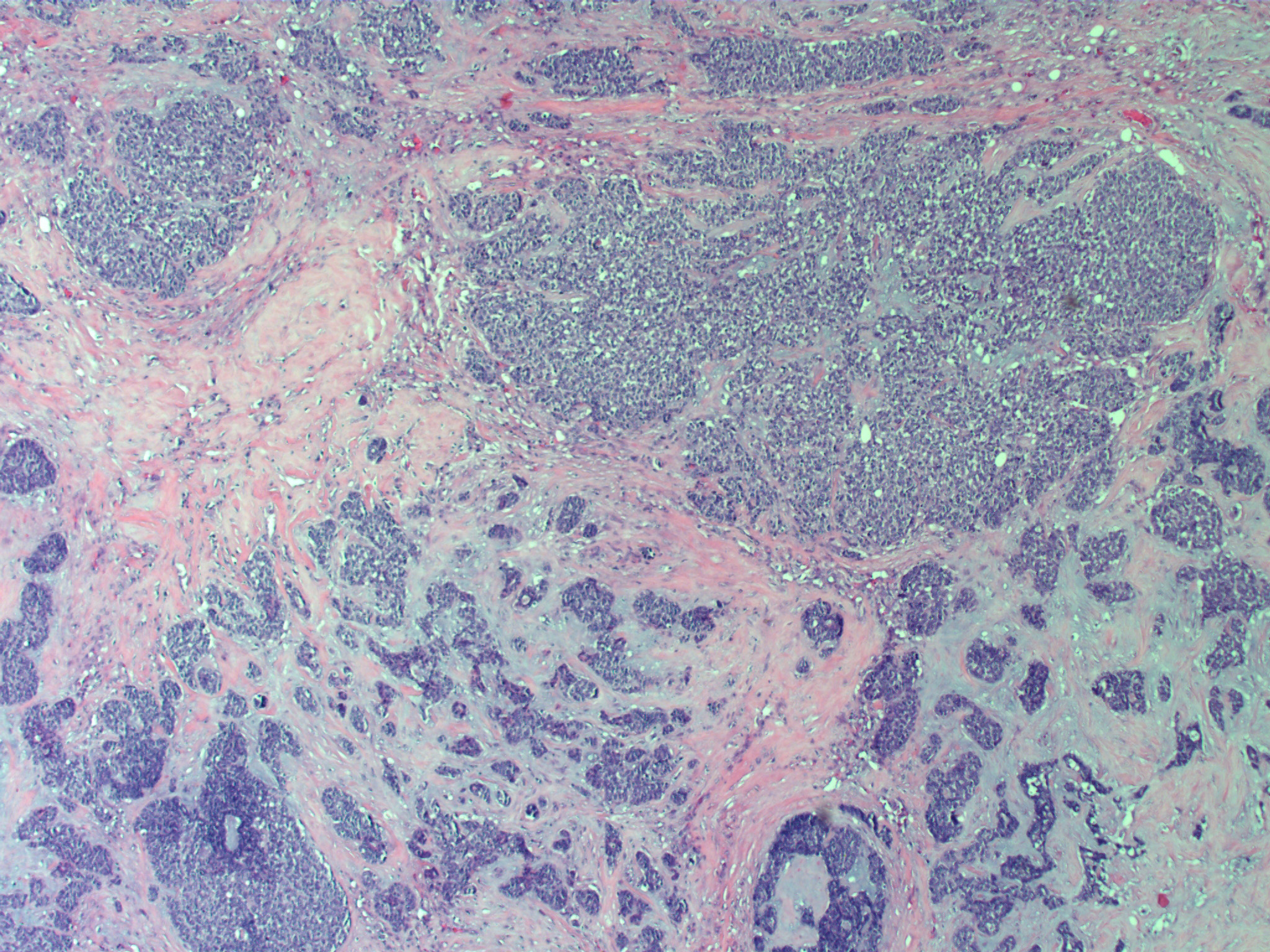 Adenoid Cystic Carcinoma Of The Breast In Men