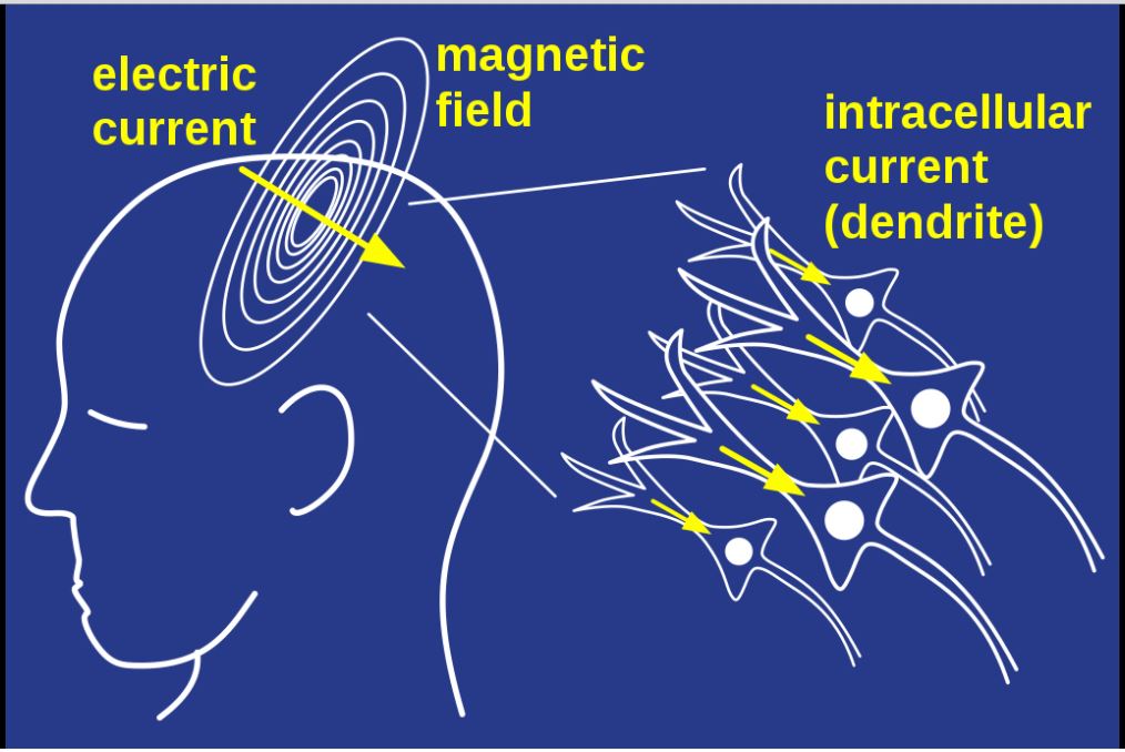 Magnetic Brain Waves To Detect Injury And Disease