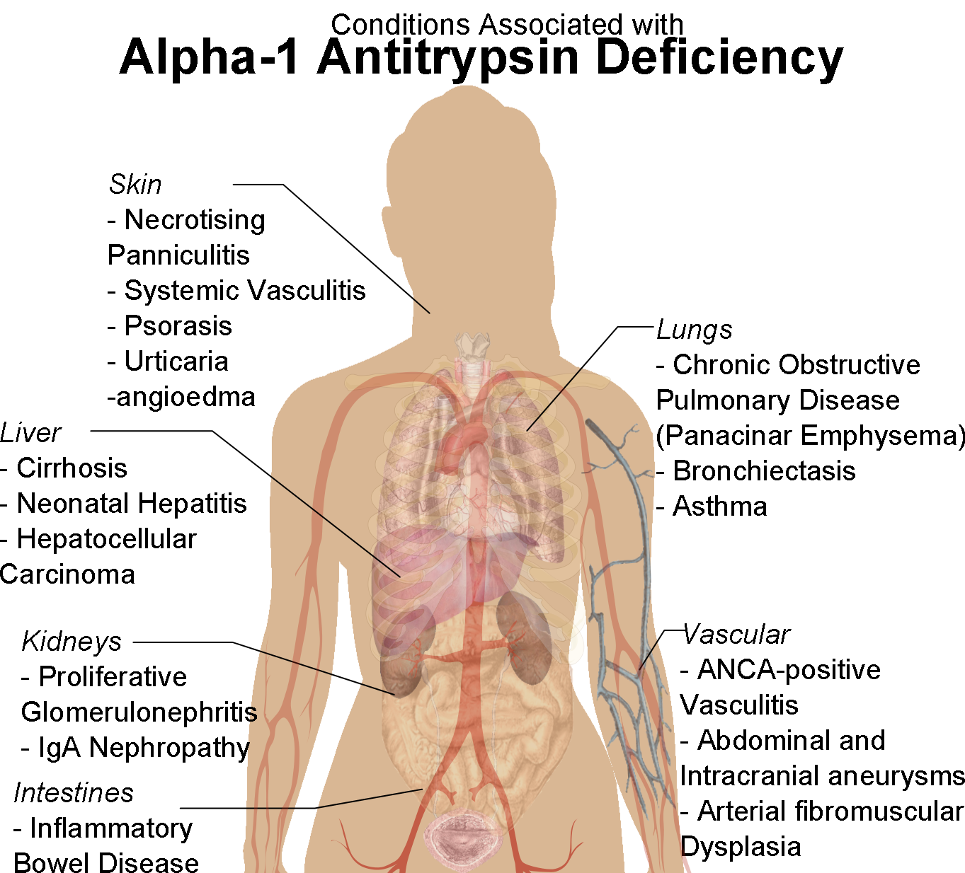 Alpha 1 Antitrypsin Deficiency