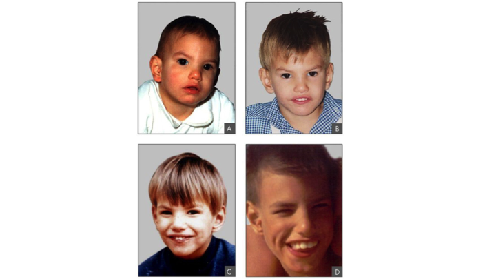 Cri du Chat Syndrome