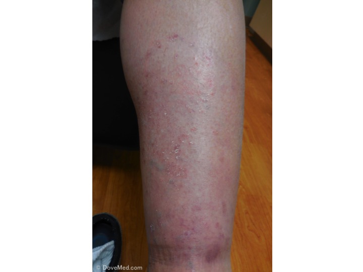 Eosinophilic Cellulitis Atypical Wells Syndrome Successfully Treated