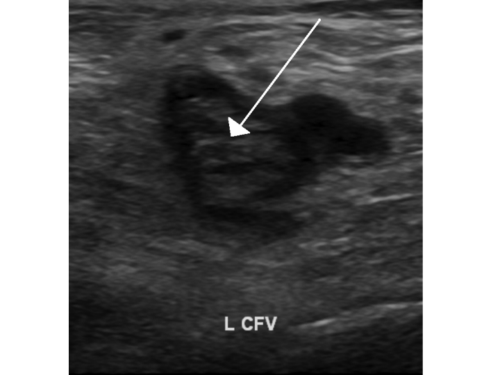 Ultrasound Imaging - Venous (Extremities)
