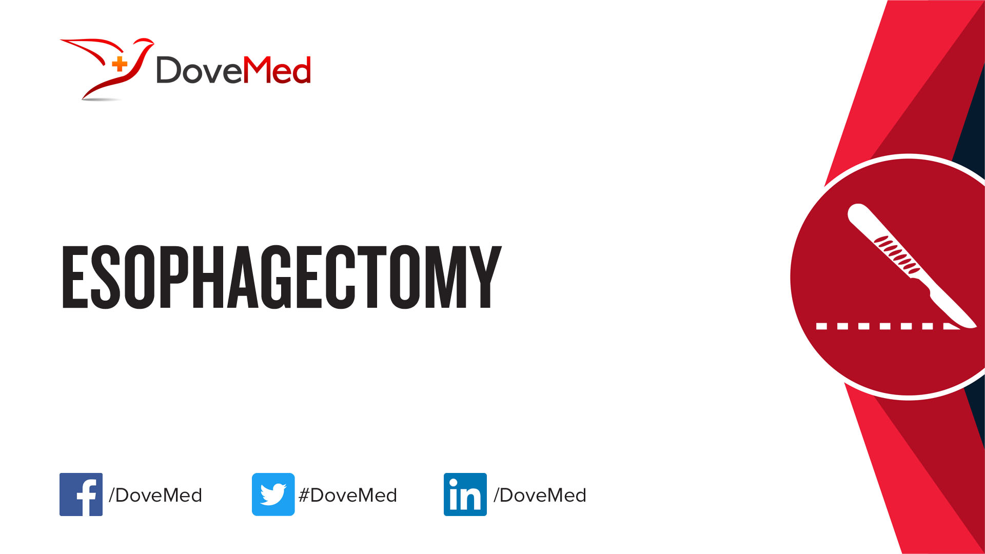 Esophagectomy