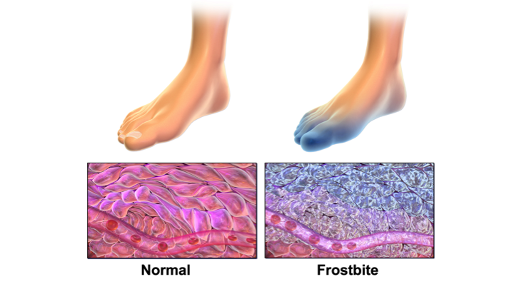 First Aid for Frostbite
