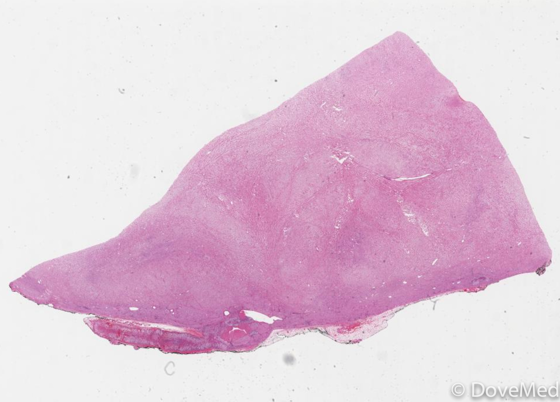 Ganglioneuroma of Appendix