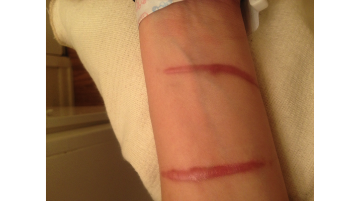 Scientists Find New Ways To Prevent Skin Scarring